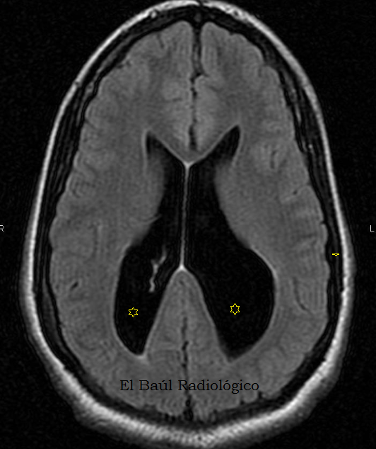 El Baúl Radiológico: DISGENESIA DEL CUERPO CALLOSO: HALLAZGOS EN TC e ...