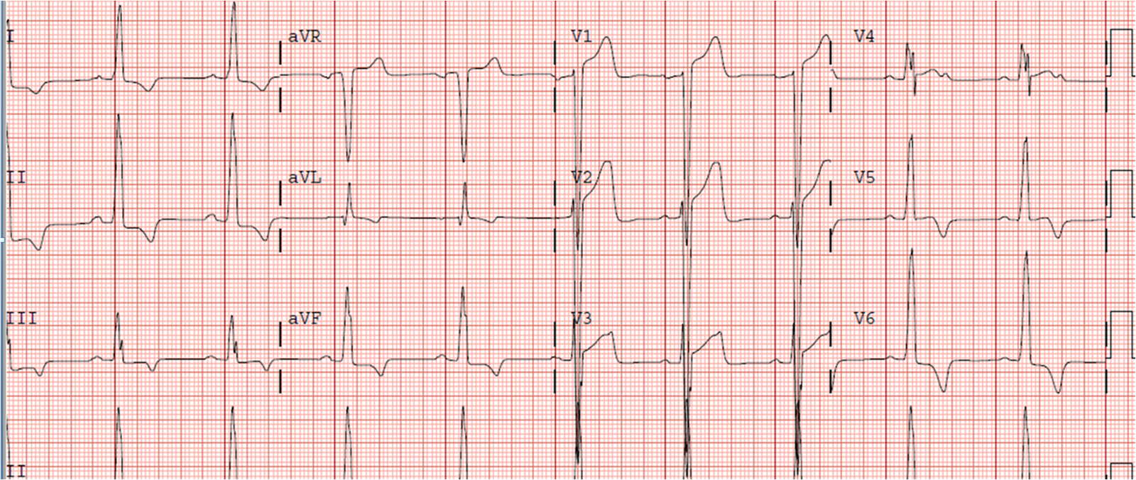 Dr. Smith's ECG Blog: Left Bundle Branch Block with Less Than 1 mm of ...
