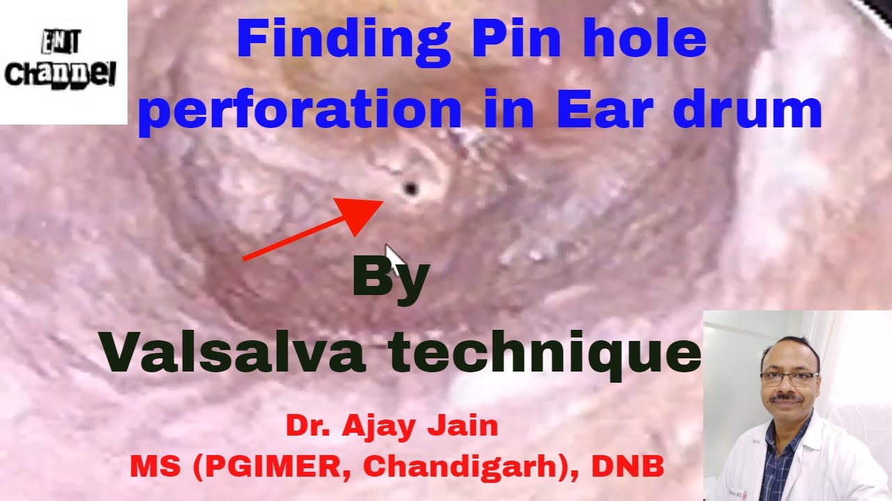 ENT Surgeon's blog: How to disclose pin hole perforation in a ...