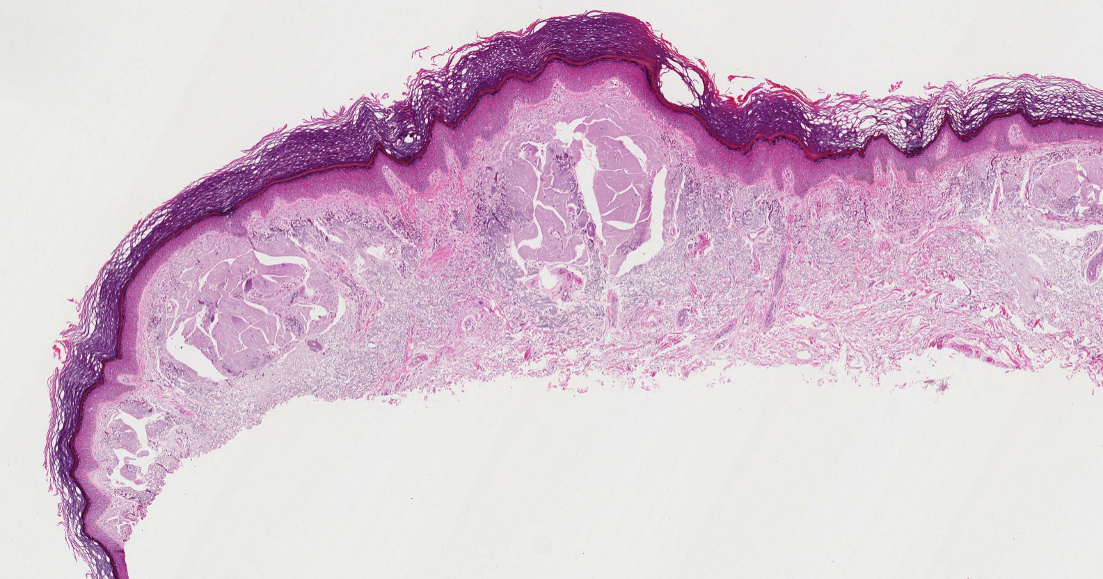 Differential Diagnosis in Dermatopathology: Pink staining
