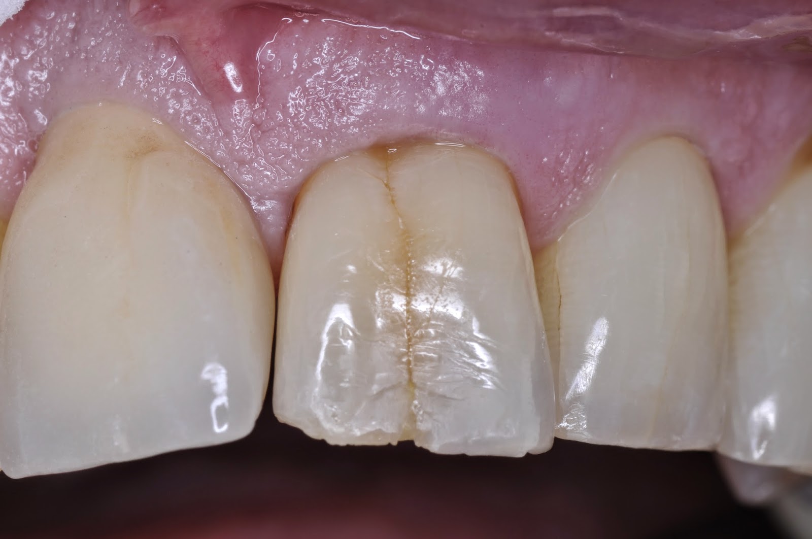 Tooth Made It To Friday