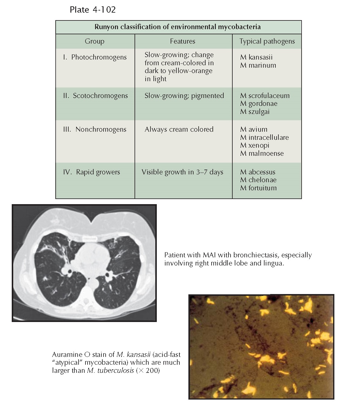 NONTUBERCULOUS MYCOBACTERIAL LUNG DISEASE - pediagenosis