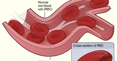 Sports Health: About Sickle Cell Disease and Athletes