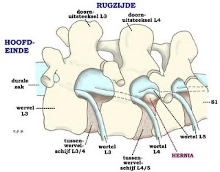 Jangeox' blog: Hernia, hernia, hernia