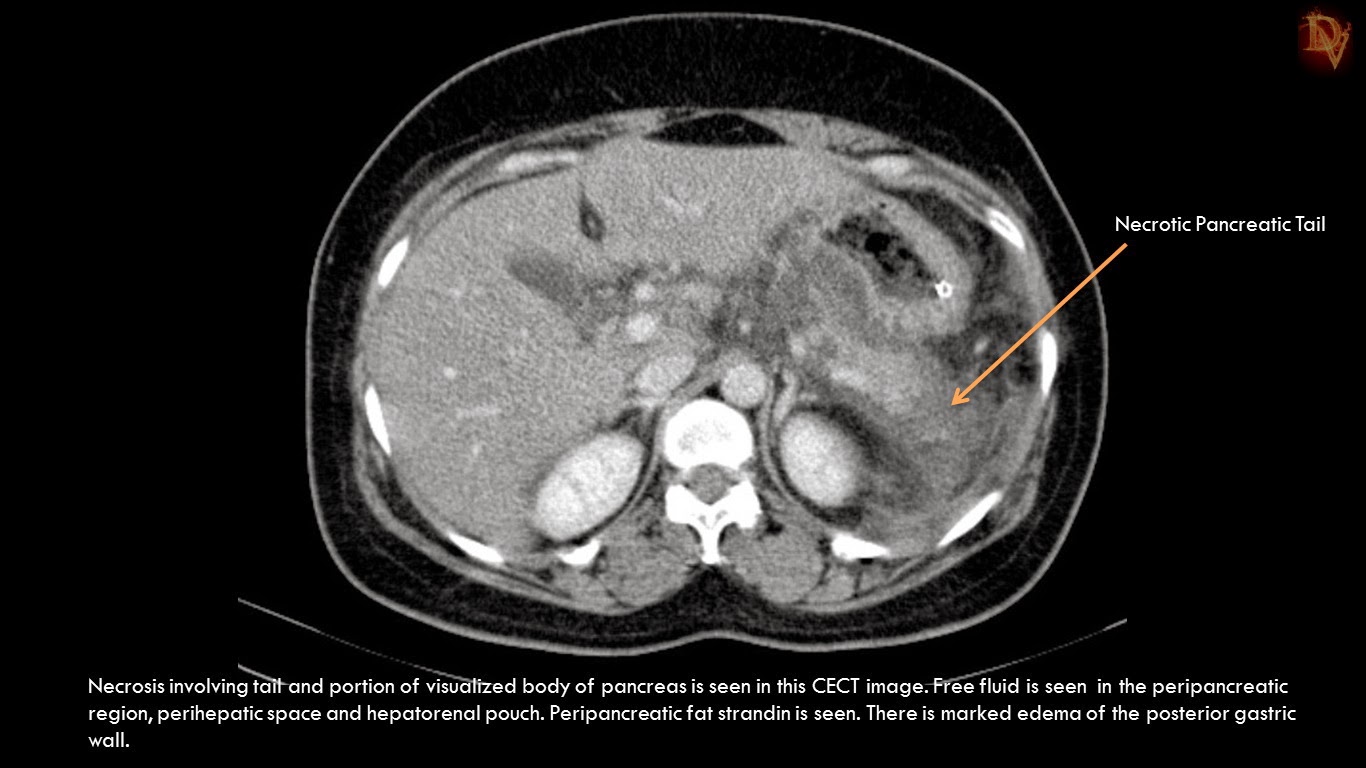 Ultimate Radiology : Acute Necrotizing Pancreatitis