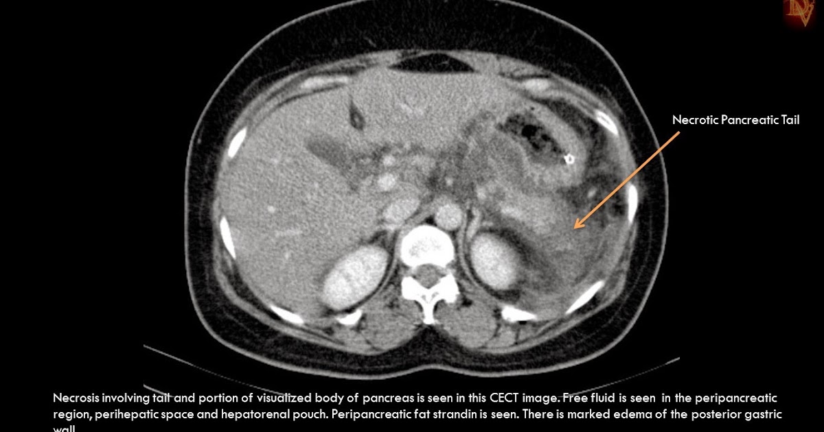 Ultimate Radiology : Acute Necrotizing Pancreatitis