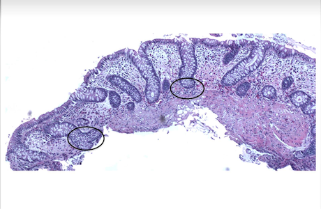 Rettocolite Ulcerosa - Studio per immagini ~ L'apparato Umano