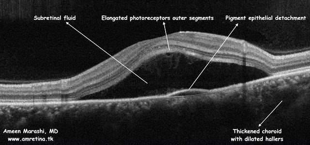 Acute Central Serous Chorioretinopathy fundus image, OCT and FFA in a ...