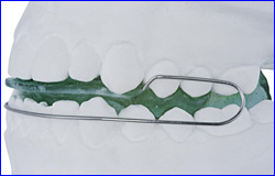 APARATOLOGIA ORTOPEDICA: BIONATOR CLASE III