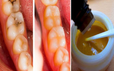Reverse Cavities Naturally And Heal Tooth Decay With THIS Powerful ...