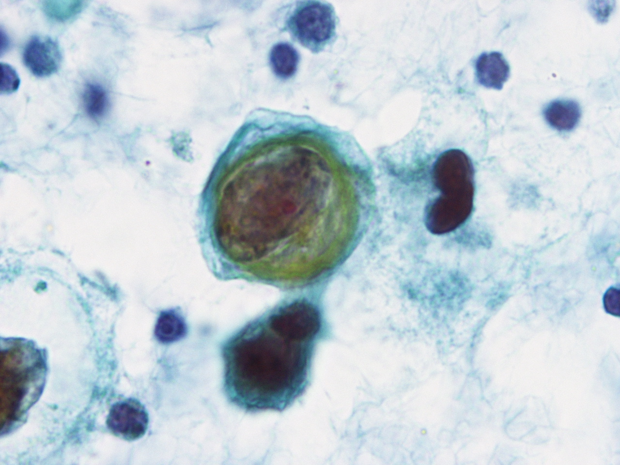 Citologia Liquida: ¿De que se trata la Citologia Liquida?