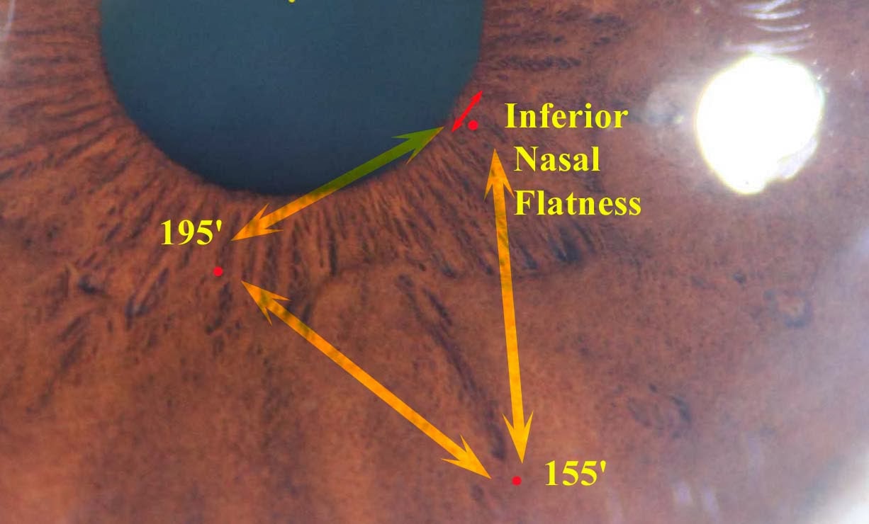 Modern & Multidimensional Iridology: The Combination of Iris Signs - Rx ...