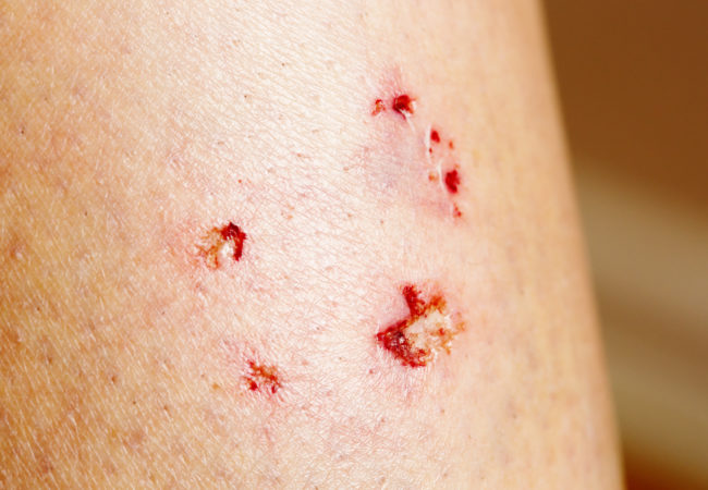 The Health Website : Dog Bites