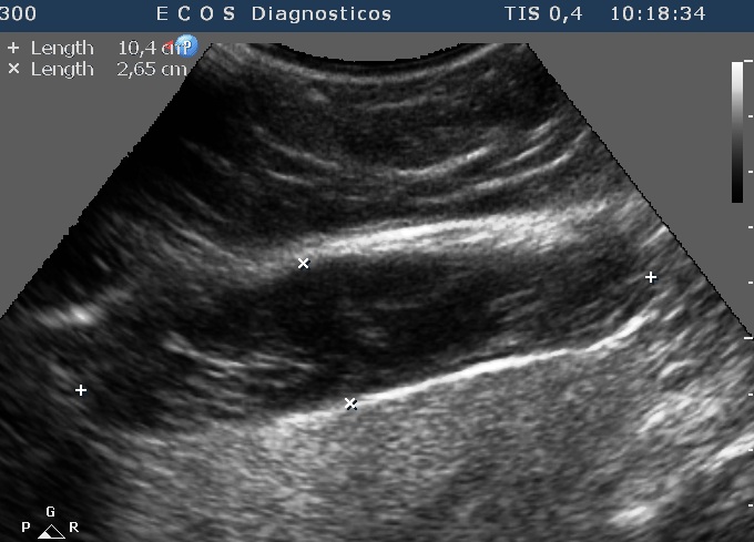 ECOGRAFIA: LIPOMA ABDOMINAL