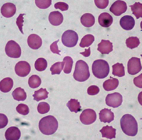 MCQ on Anemia Classification, Pathogenesis and Diagnosis: Pathology