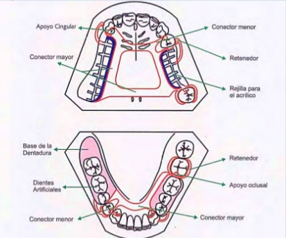 Prótesis Parcial Removible (PPR)