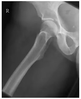 Lauenstein's projection ( posterior oblique ) - paramedical guru