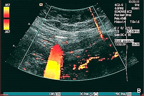DR. JUAN HERNÁNDEZ ORDUÑA. : Casos especiales en apendicitis aguda texto