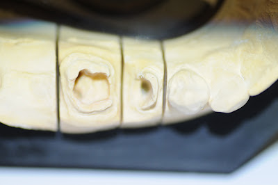 Empreintes TFM: Tenon faux moignon IC: Inlay core ACR: Ancrage corono ...