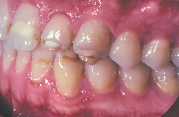 Dental Journal: Indications of Enamel Dysplasia