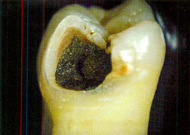 PDF: Manejo terapéutico de caries dentinaria profunda