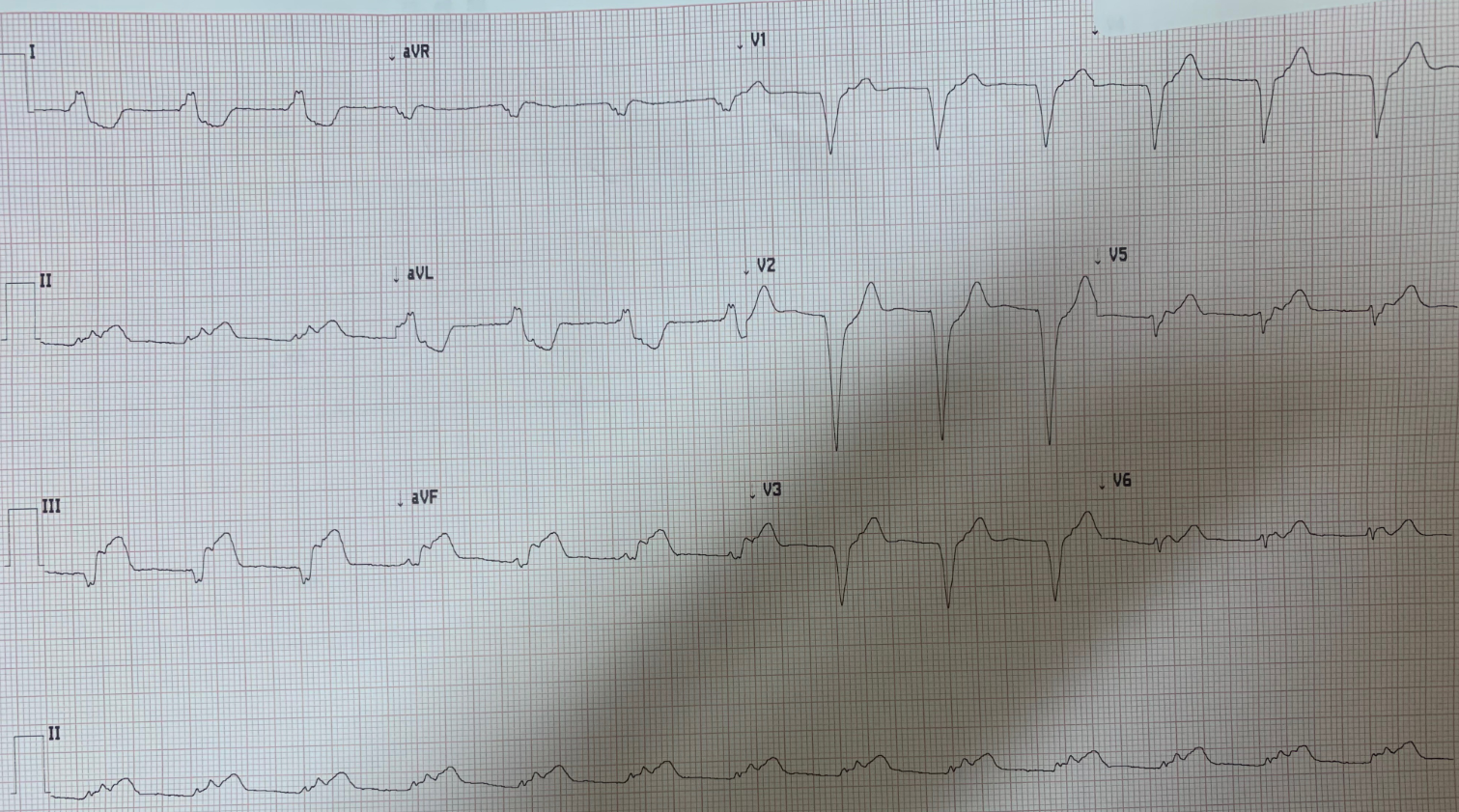 Dr. Smith's ECG Blog: Which Modified Sgarbossa Rule does this meet? And ...