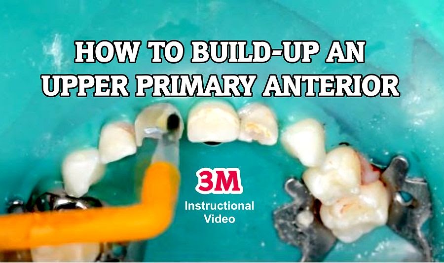 PEDIATRIC DENTISTRY: How to build-up an upper primary anterior in a 3 ...