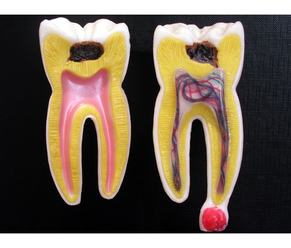 Pulpotomía y Pulpectomía. Diferencias. En que casos se realizan ...