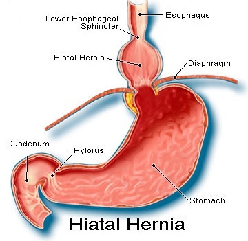 Hiatus Hernia Info: Hiatus Hernia Signs and symptoms and Organic ...