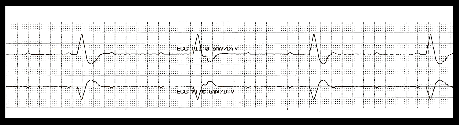 Various Third Degree Heart Blocks