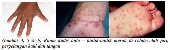 Cara Atasi Penyakit Kudis Buta