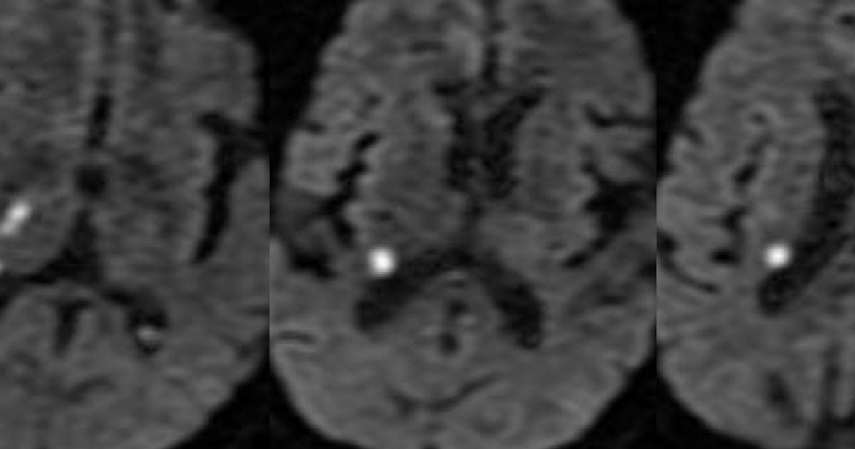 Neuroradiology Cases: Anterior Choroidal Artery Infarct