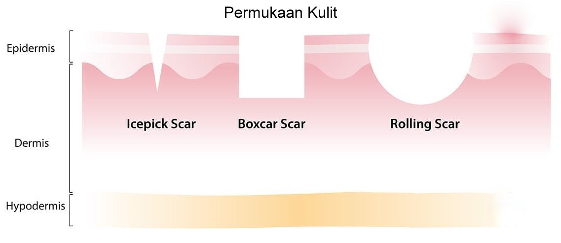 Bopeng? Apakah Bopeng benar-benar bisa Hilang?