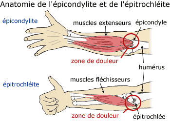 Blog 75: Infos santé : Kiné Ostéo-Epicondylites