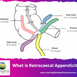 Appendix surgery in Chennai