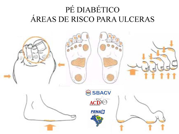 Atenção... Diabéticos Com Seus Pés