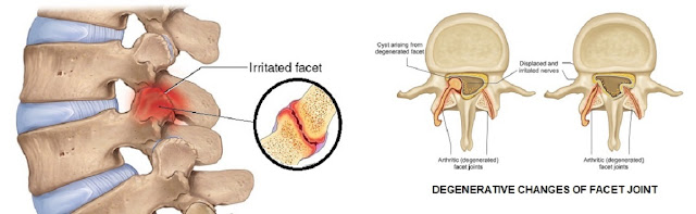 FACET JOINT PAIN OR SYNDROME EXERCISES, CAUSES, SYMPTOMS AND TREATMENT
