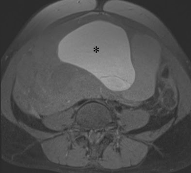 mricases: Large Degenerative Hemorrhagic Sessile Subserosal Uterine Fibroid