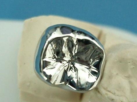 Conventional Casting Full Metal Crown And Bridge ~ Dr. Bharat Katarmal ...