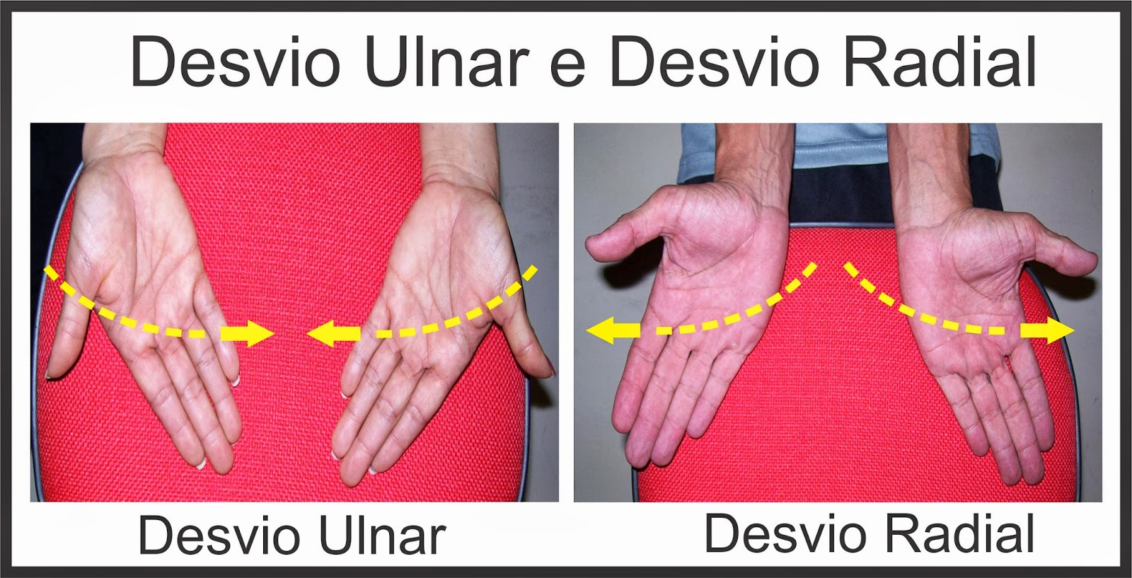 Desvio Ulnar E Radial - RETOEDU