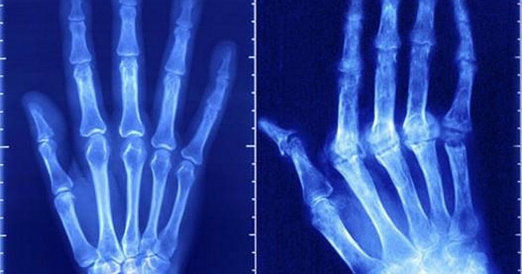 Toda Moderna: Artrite reumatoide - Conheça a doença, causas, sintomas ...