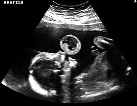 Pro Life in TN: Pre born receives life saving surgery at 17 weeks ...