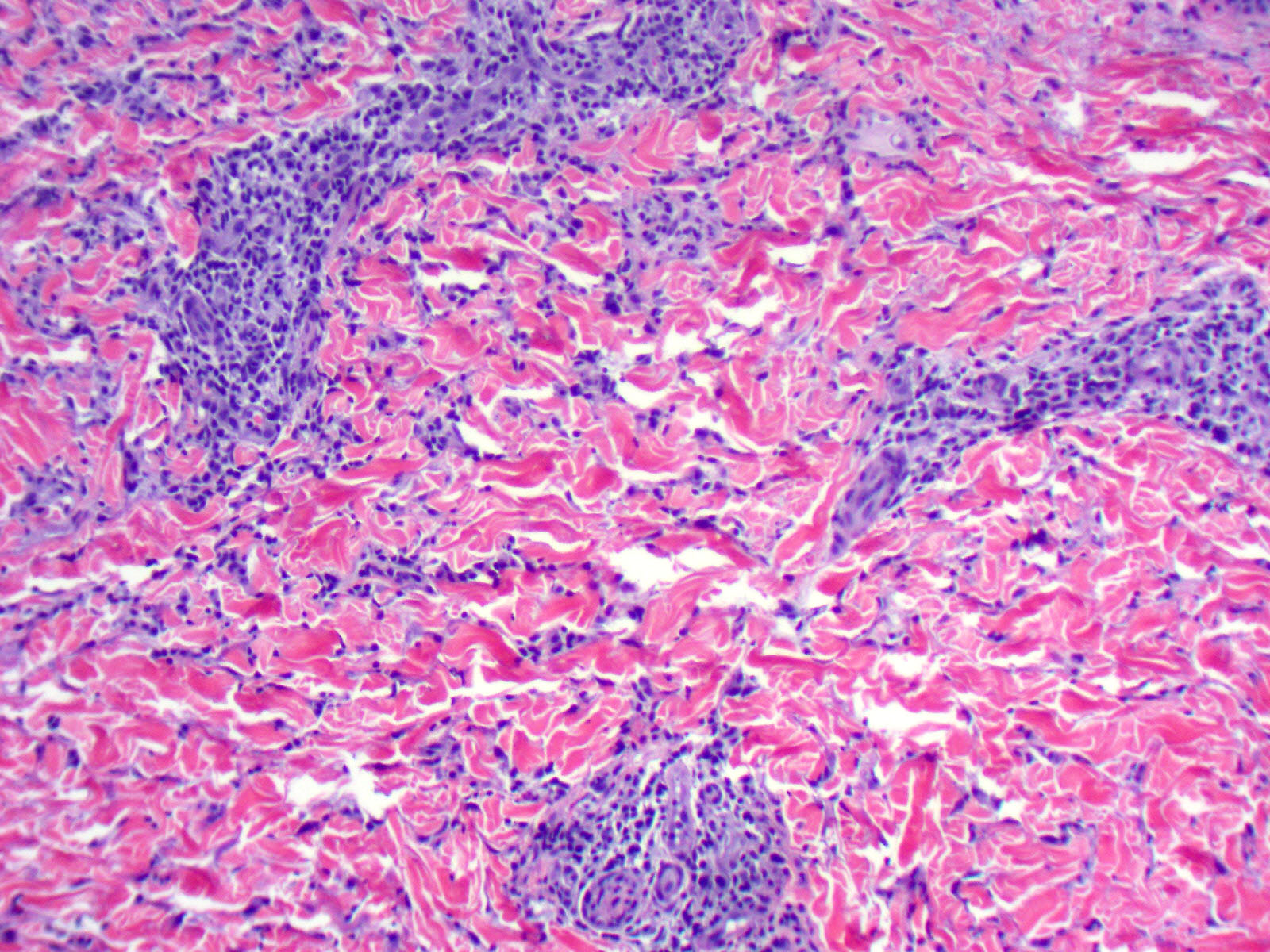 VIRTUAL GRAND ROUNDS IN DERMATOLOGY 2.0: Interstitial Granulomatous ... VIRTUAL GRAND ROUNDS IN DERMATOLOGY 2.0: Interstitial Granulomatous ...