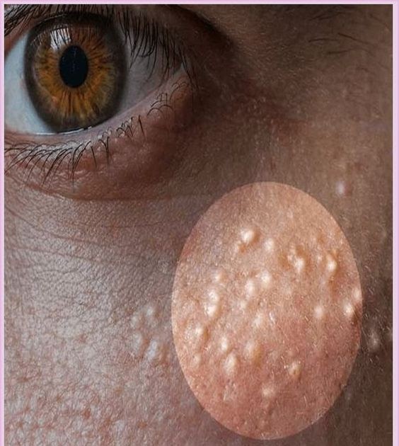 7 Remedies To Get Rid Of Cholesterol Milk Spots Naturally - wellness days