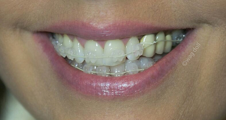 I GOT BRACES! My Six Month Smile Video Diary: Day 1