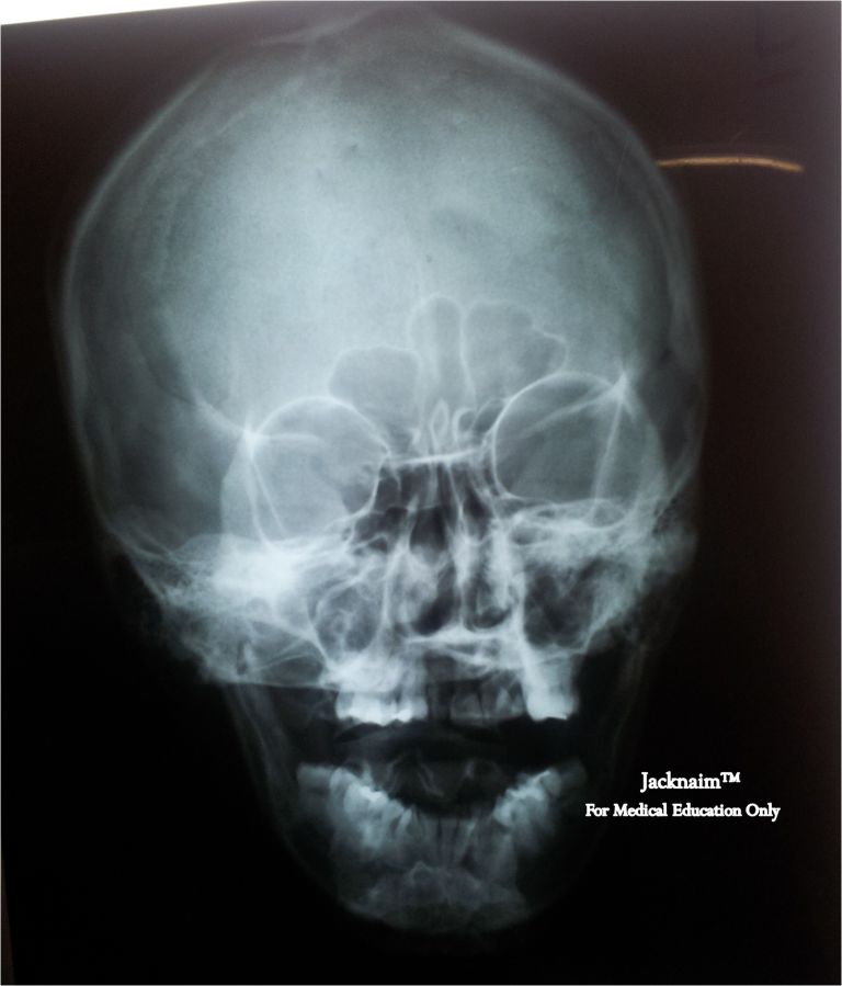My Medical Notes: Left TMJ Dislocation