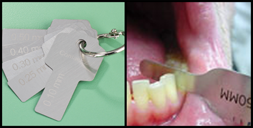 Sneek's Invisalign Treatment: My Interproximal Reduction (Shaving Tooth ...