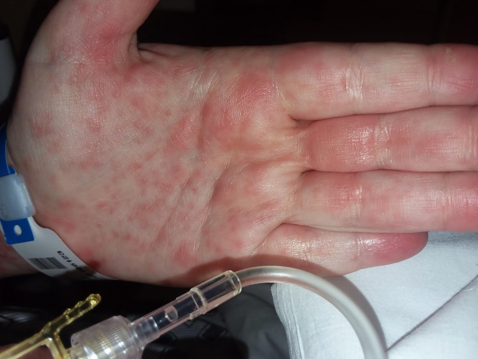 VIRTUAL GRAND ROUNDS IN DERMATOLOGY 2.0: Generalized Pustular Eruption ...