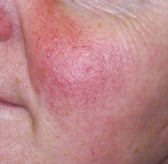 Beauté et Santé: Joue rouge? Il pourrait être la rosacée