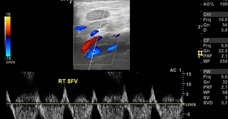 Ultrasound imaging: Pulsatile-flow-in-veins
